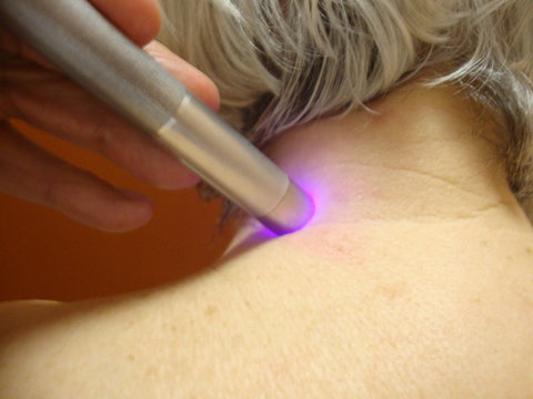 Láser sistema FP3 - CEMATEC